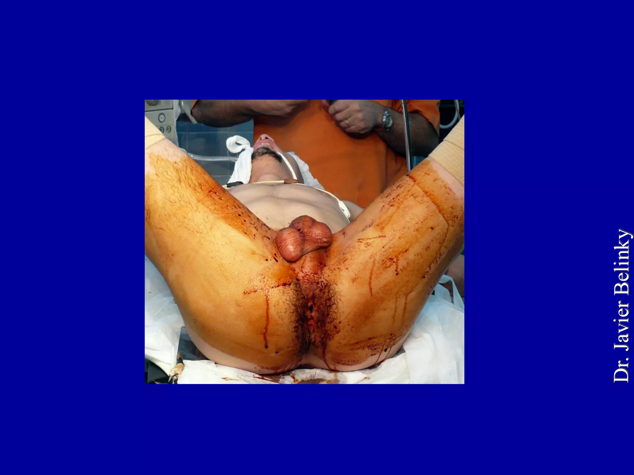 Resection and primary anastomosis in bulbar urethral strictures ...