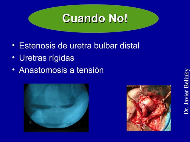 Resection and primary anastomosis in bulbar urethral strictures ...