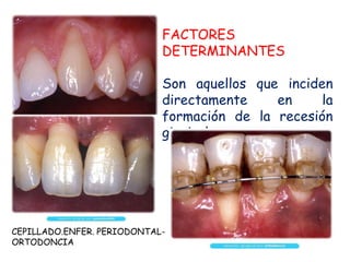 Clasificación De La Recesión Gingival