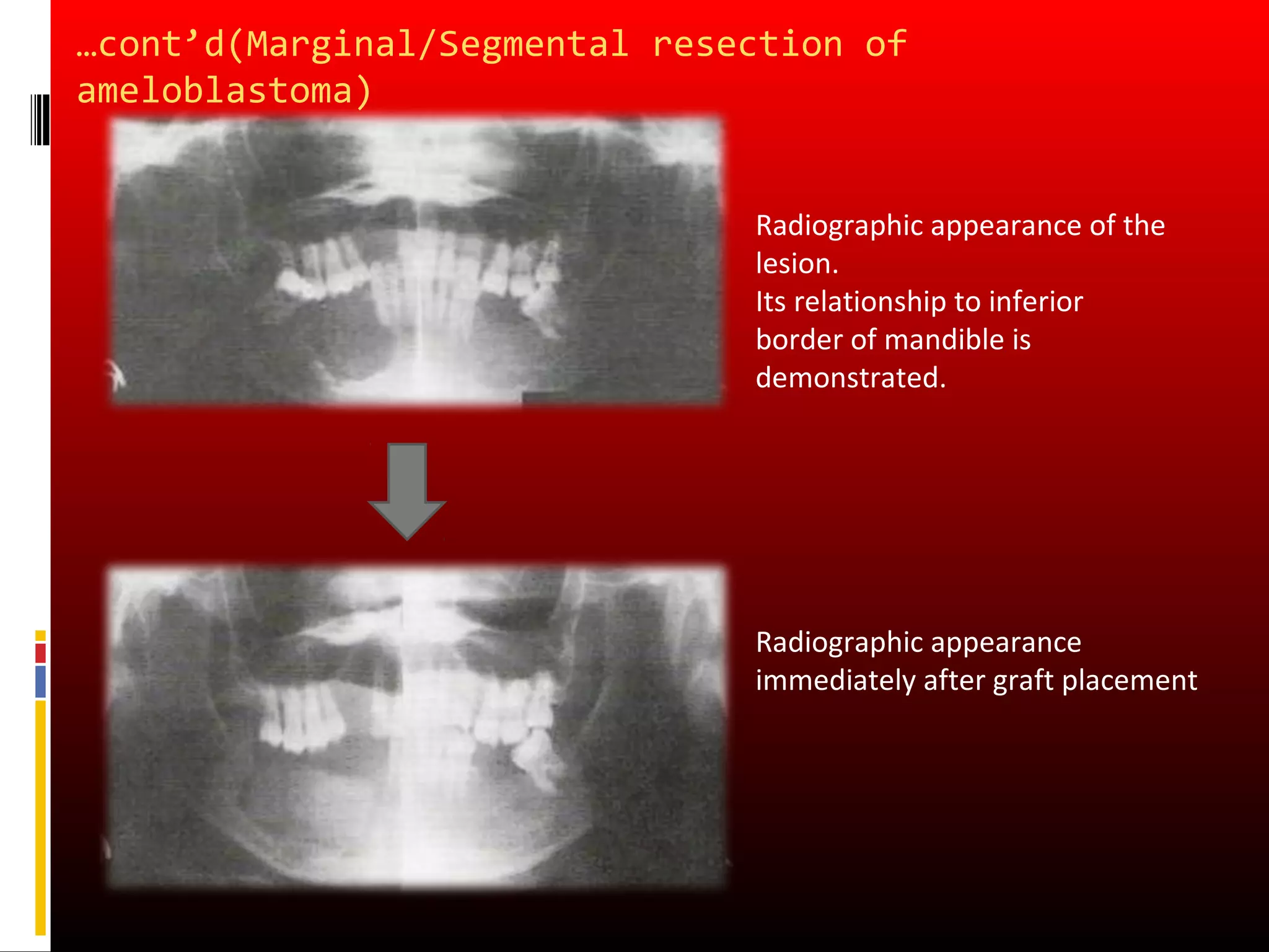 Resection oral surgery (very simplified) | PPT