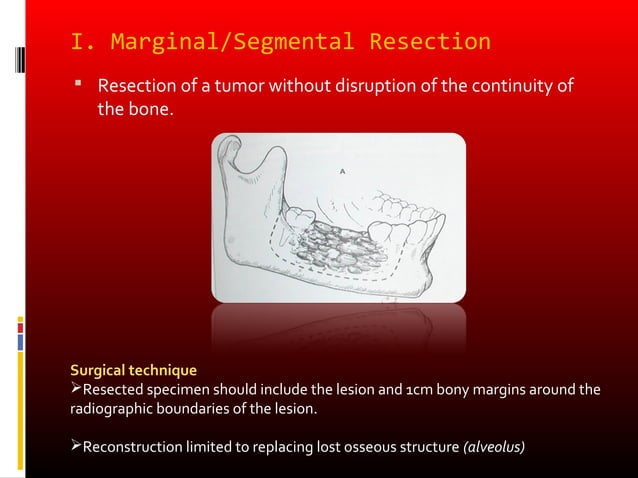 Resection oral surgery (very simplified) | PPT | Dental Health ...