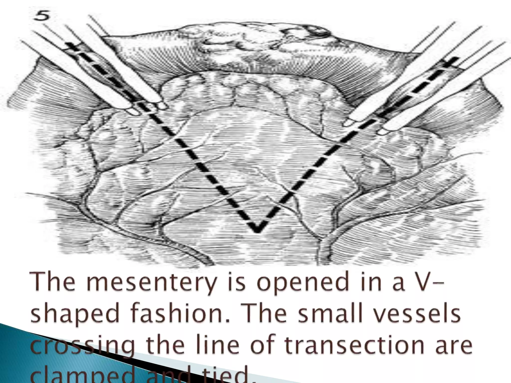 Resection & anastomosis of boweL its complications PRANAYA PPT | PPTX