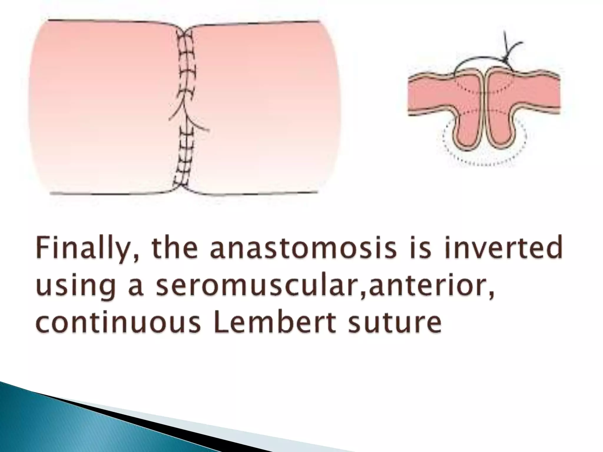 Resection & anastomosis of boweL its complications PRANAYA PPT | PPTX
