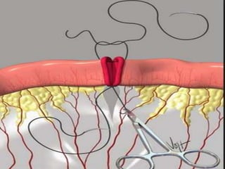 Resection & anastomosis of boweL its complications PRANAYA PPT | PPTX