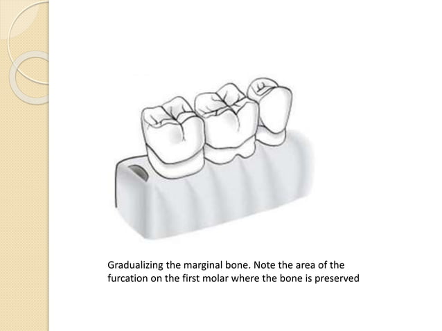 Resective osseous surgery.pptx