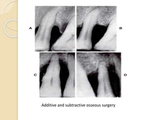 Resective osseous surgery.pptx