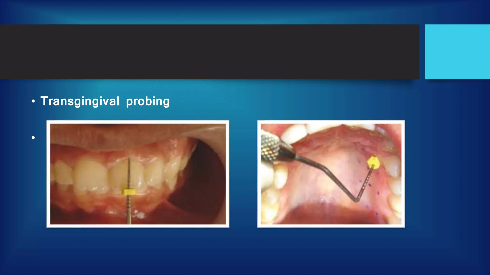 Resective osseous surgery | PPTX