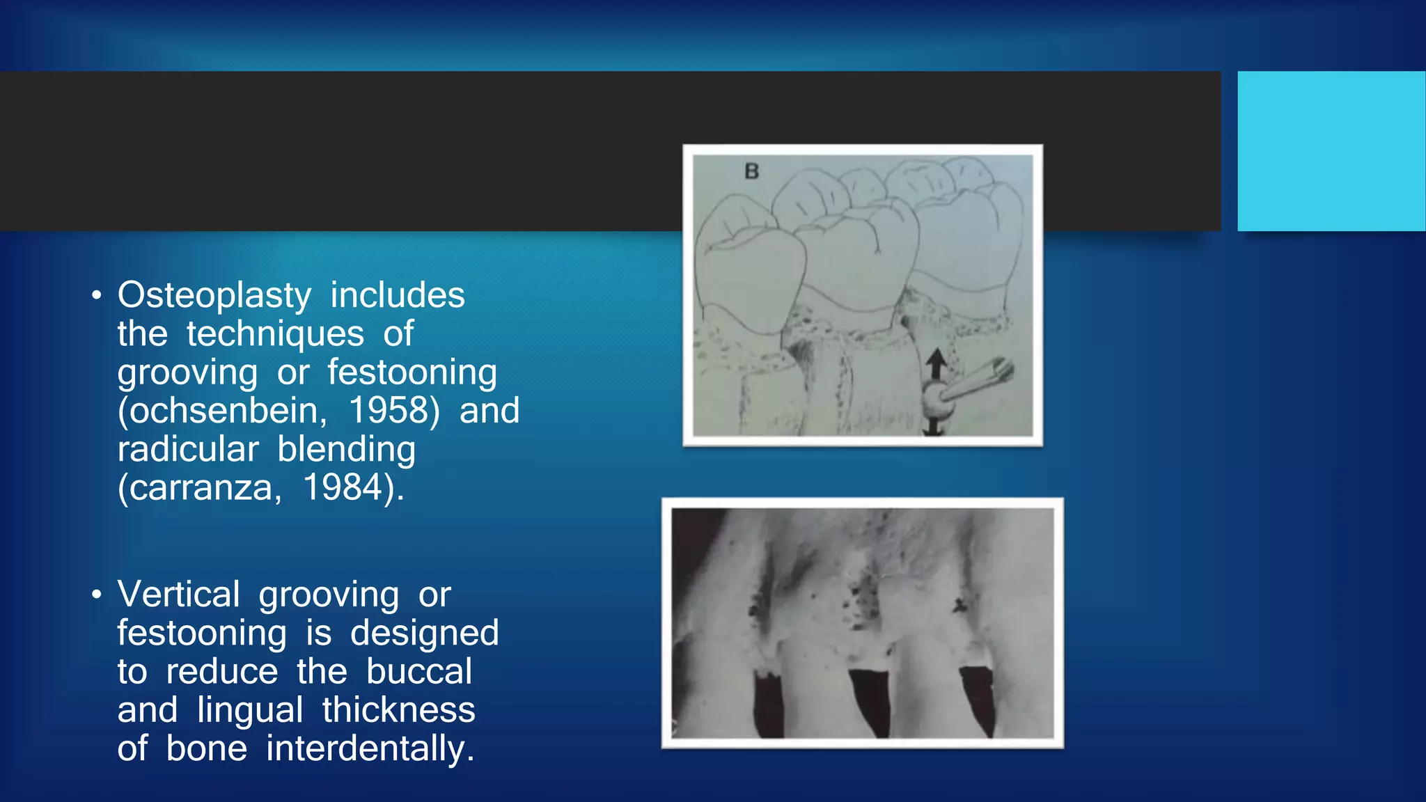 Resective osseous surgery | PPTX