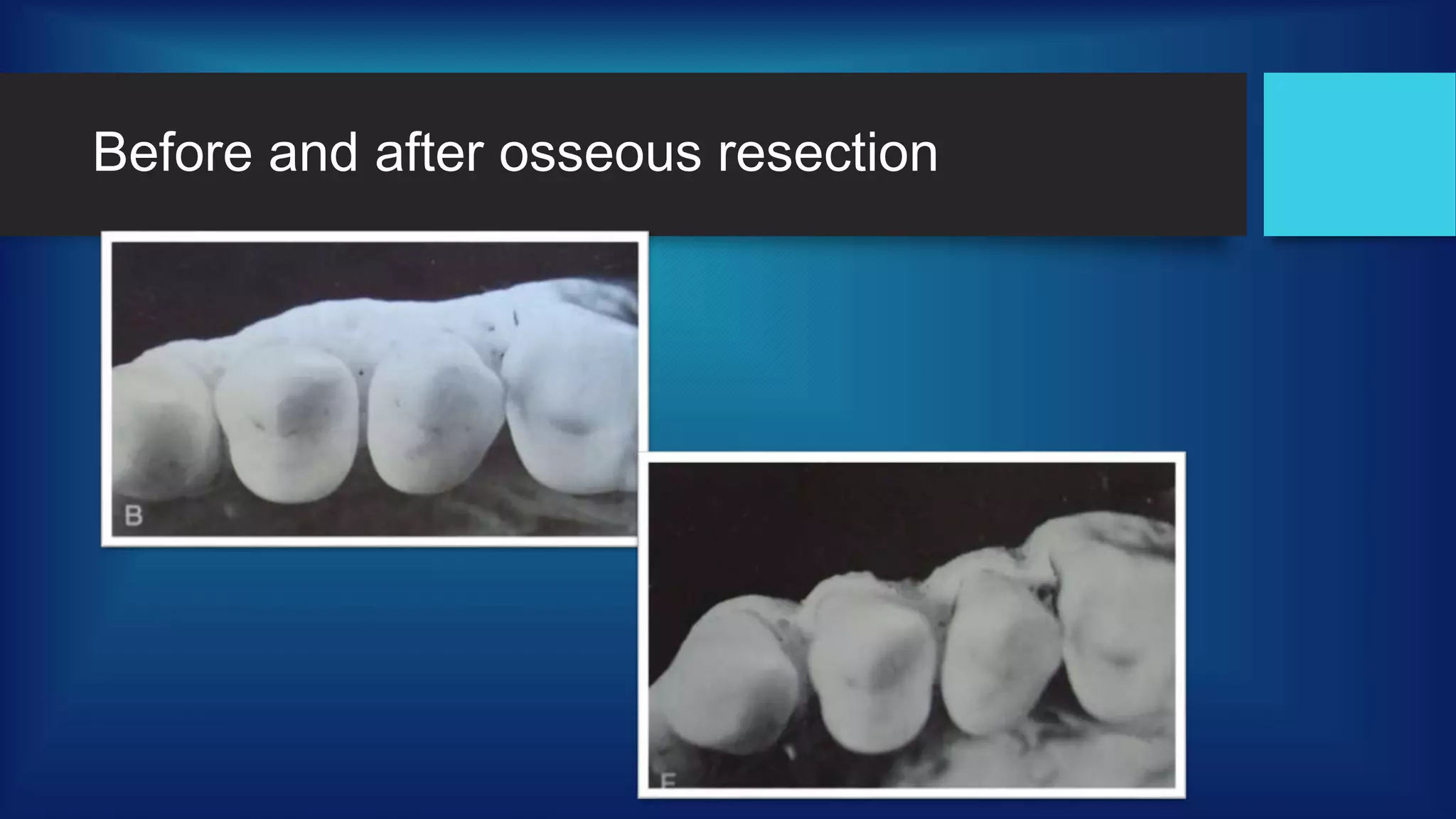 Resective osseous surgery | PPTX