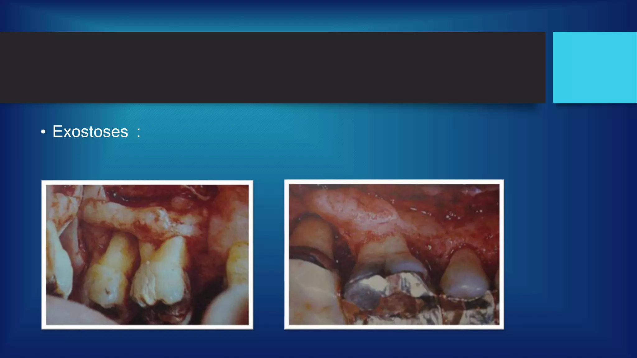 Resective osseous surgery | PPTX