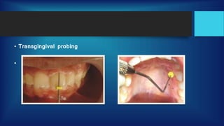 Resective osseous surgery | PPTX