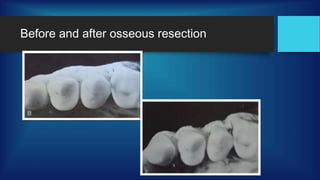 Resective osseous surgery | PPT
