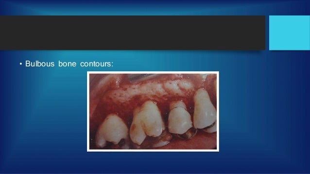 Resective osseous surgery