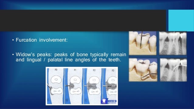 Resective osseous surgery