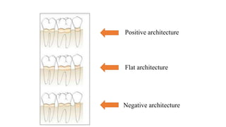 Resective osseous surgery | PPTX