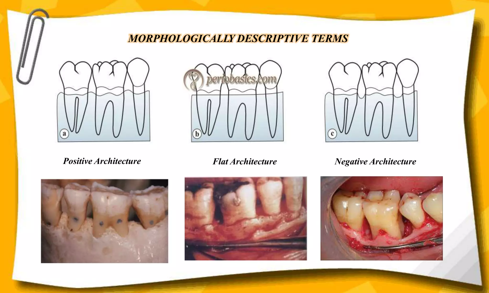 Resective osseous surgery | PPTX