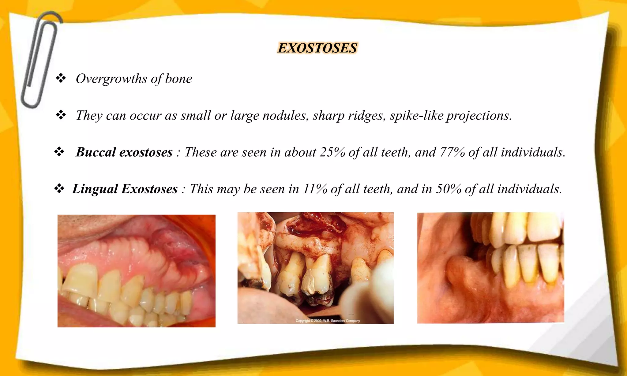Resective osseous surgery | PPTX