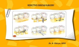 Resective osseous surgery | PPTX