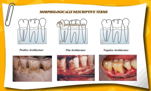 Resective osseous surgery | PPTX | Bone and Joint Conditions | Diseases ...