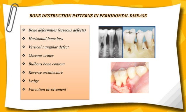 Resective osseous surgery | PPTX | Bone and Joint Conditions | Diseases ...