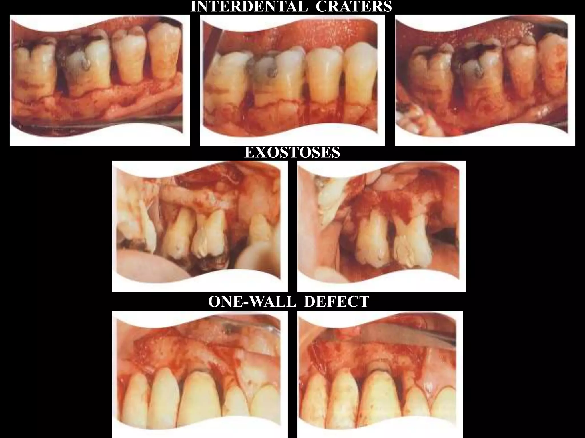 RESECTIVE OSSEOUS SURGERY.ppt
