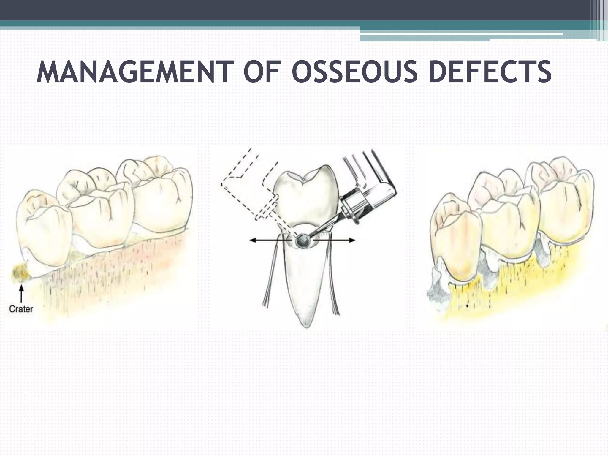 RESECTIVE OSSEOUS SURGERY.pptx