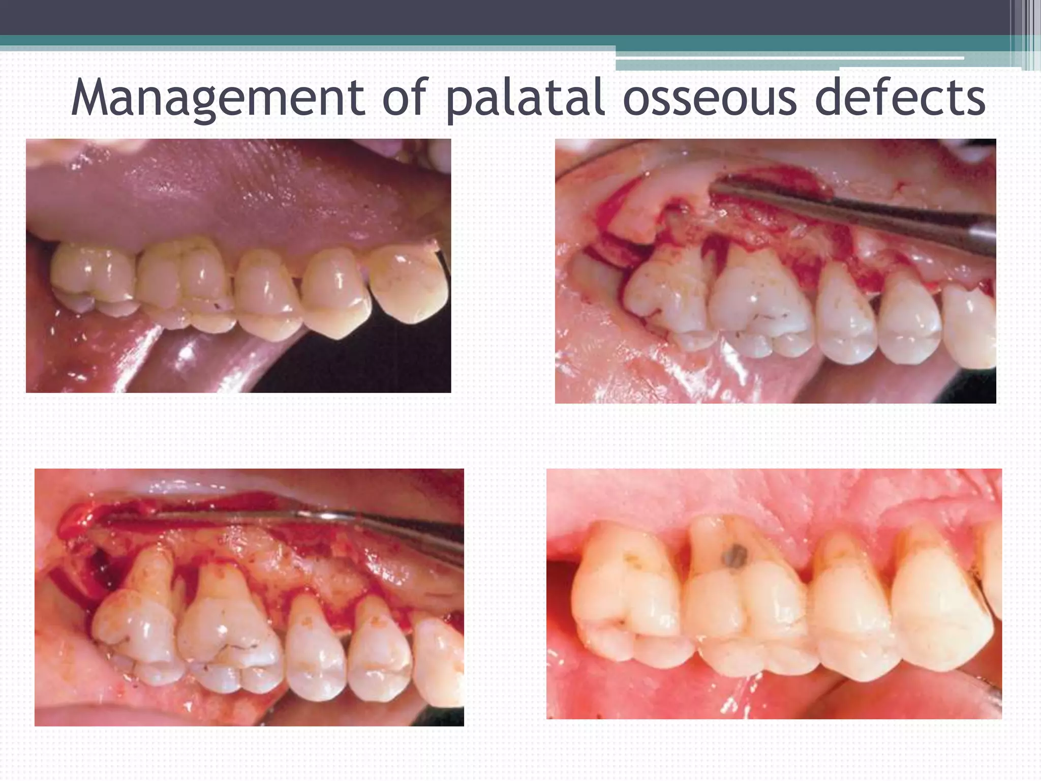 RESECTIVE OSSEOUS SURGERY.pptx
