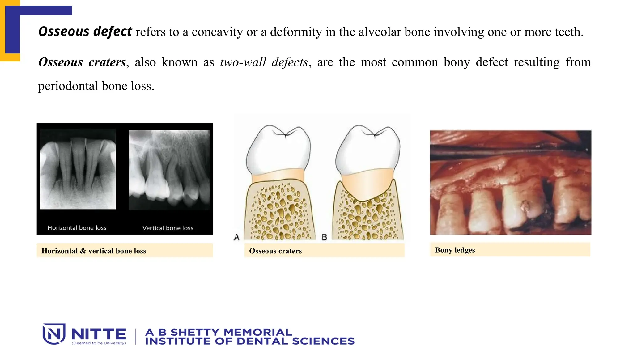 RESECTIVE OSSEOUS SURGERY : Precision Reshaping for Periodontal Health ...