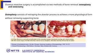 RESECTIVE OSSEOUS SURGERY : Precision Reshaping for Periodontal Health ...