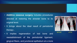 resective osseous surgeryyy.pptx