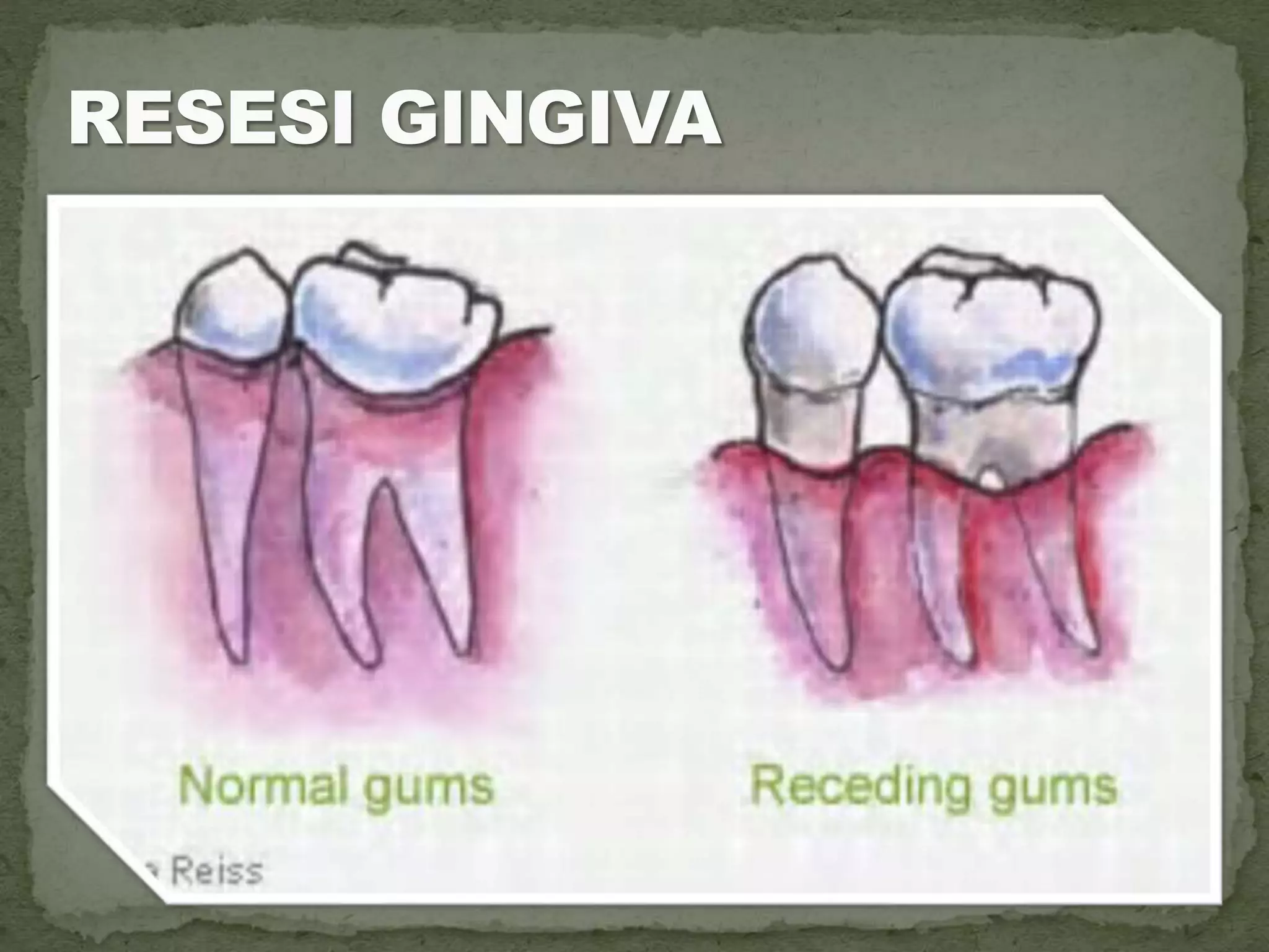 Resesi gingiva. | PPTX