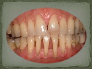 Resesi gingiva. | PPTX