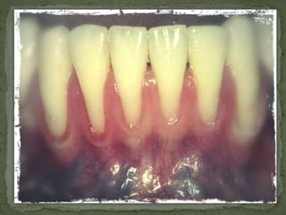 Resesi gingiva. | PPTX