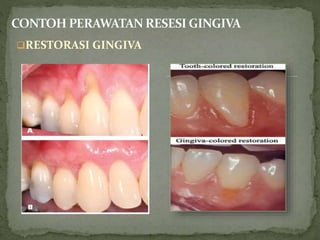 Resesi gingiva. | PPTX