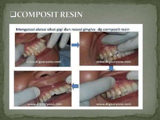 Resesi gingiva. | PPTX