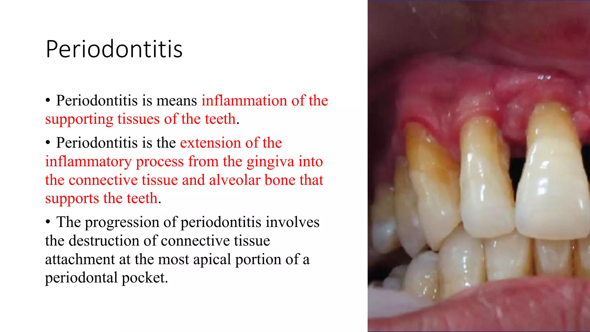 Diagnosis of periodontal disease | PPSX