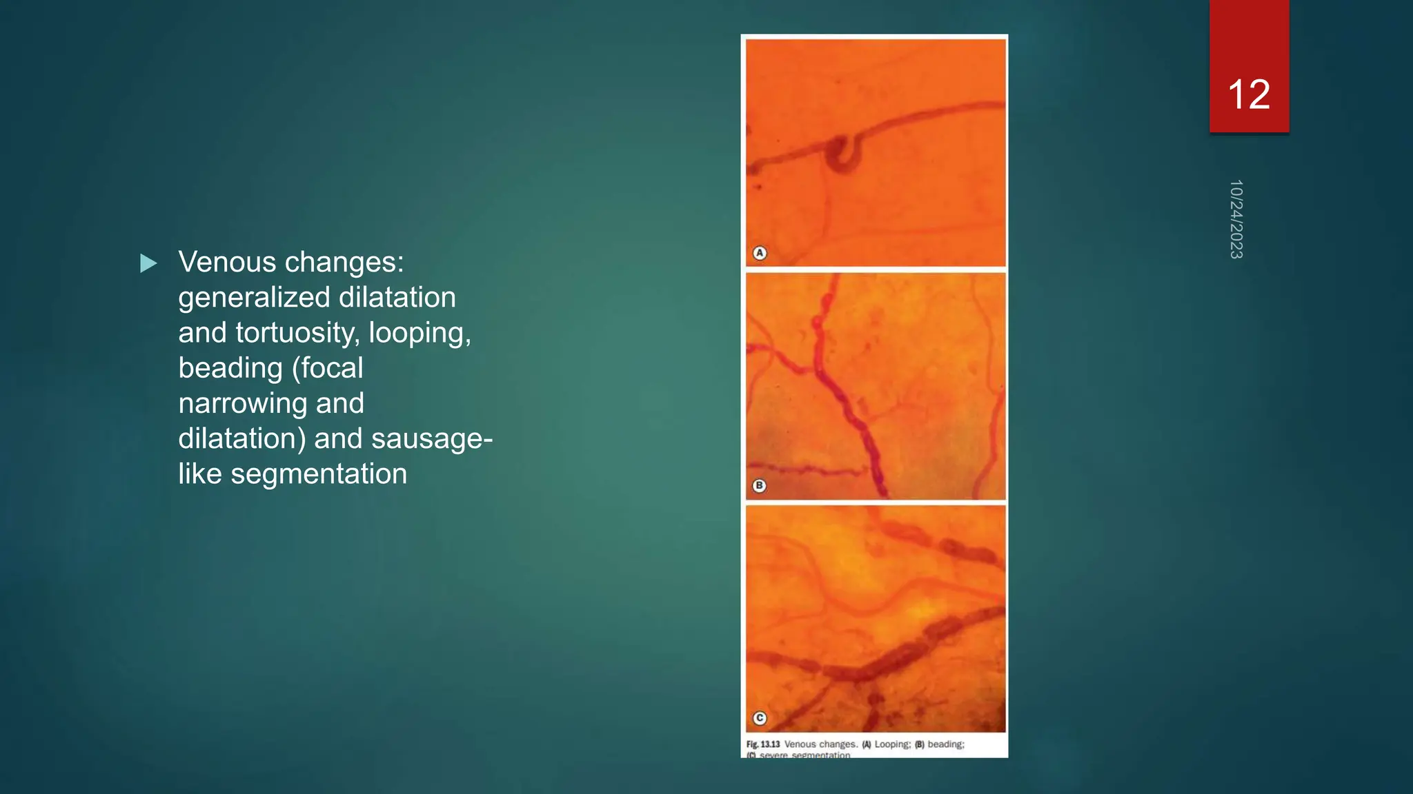 DIABETIC RETINOPATHY.pptx
