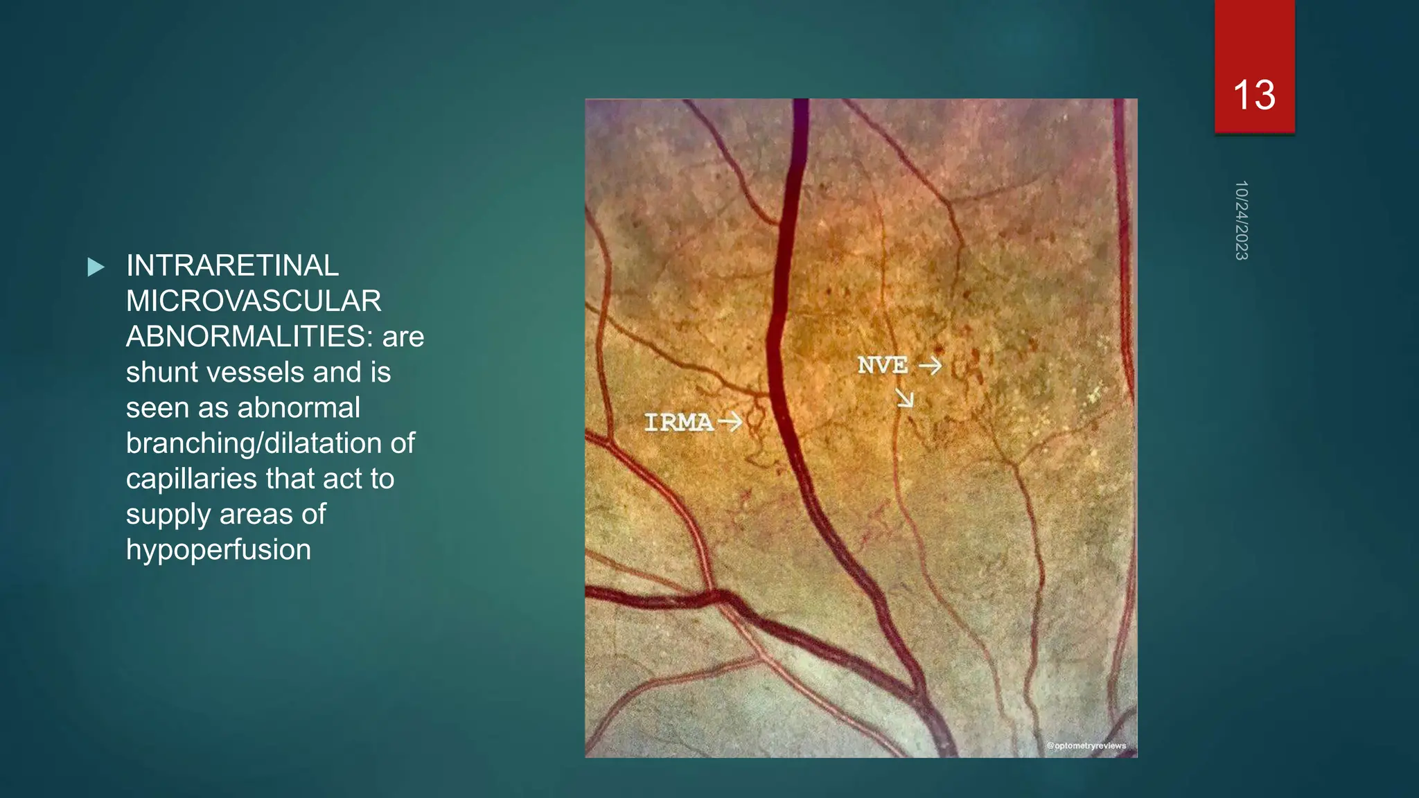 DIABETIC RETINOPATHY.pptx