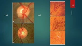 DIABETIC RETINOPATHY.pptx