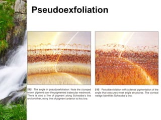 Pseudoexfoliation Gonioscopy