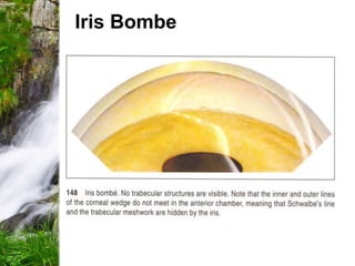 Iris Bombe Gonioscopy