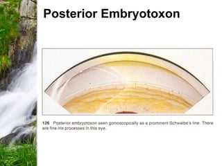Posterior Embryotoxon Gonioscopy