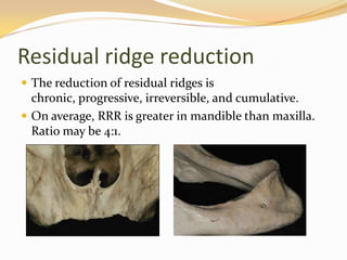 Residual ridge reduction and flabby ridges | PPSX