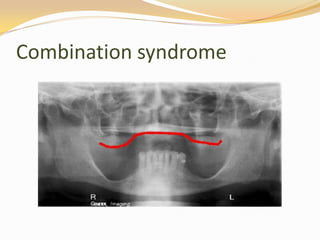 Residual ridge reduction and flabby ridges | PPSX