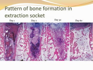 Residual ridge reduction and flabby ridges | PPSX