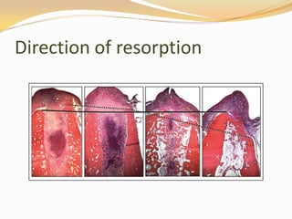 Residual ridge reduction and flabby ridges | PPSX