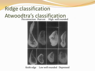 Residual ridge reduction and flabby ridges | PPSX