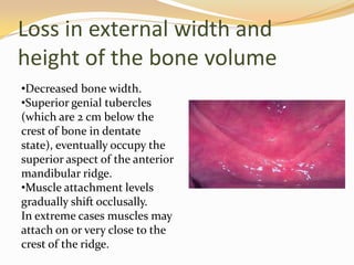 Residual ridge reduction and flabby ridges | PPSX