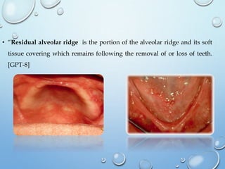 Residual ridge resorption | PPT