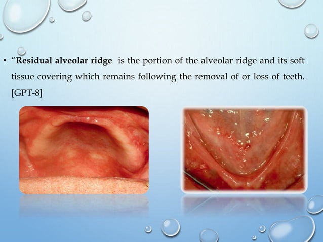 Residual ridge resorption | PPT